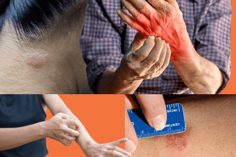 Treat and Prevent Tinea with Dermo Direct