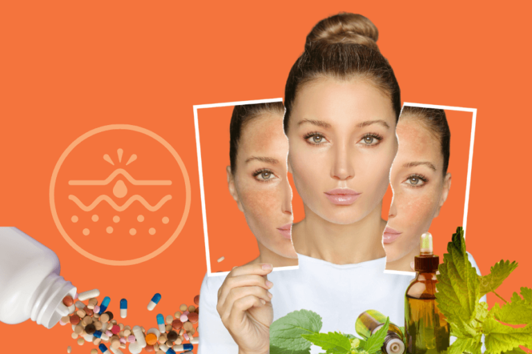 Acne, Eczema & Psoriasis: Causes, Symptoms & Treatments